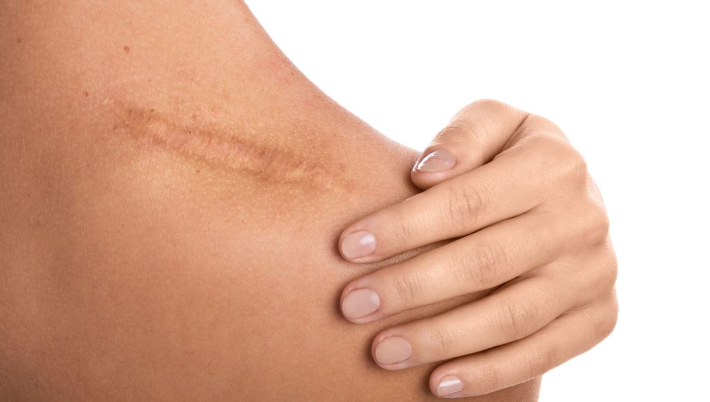 Narbenpflege - Wie pflege ich meine Narbe richtig | SAPURA®